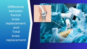 Difference Between Partial And Total Knee Replacement